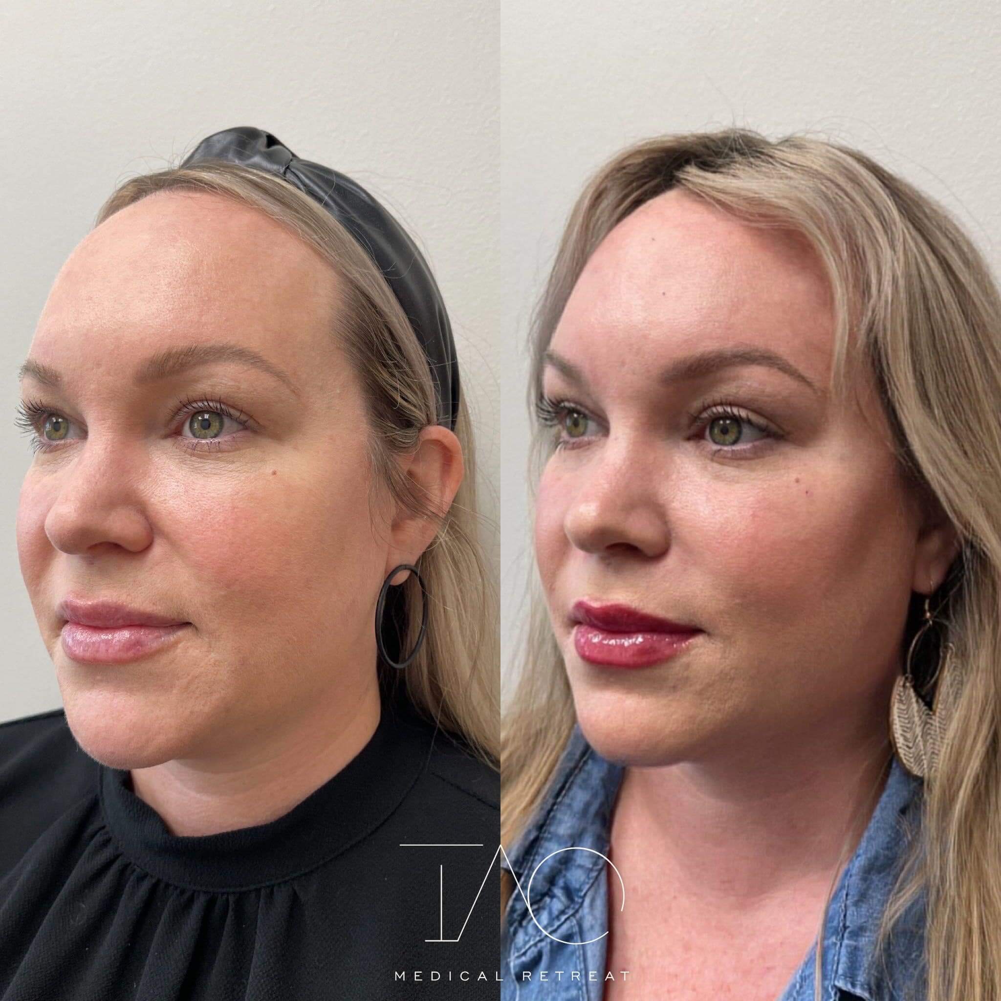 Dermal Fillers Before & After Photos | TAO Medical Spa