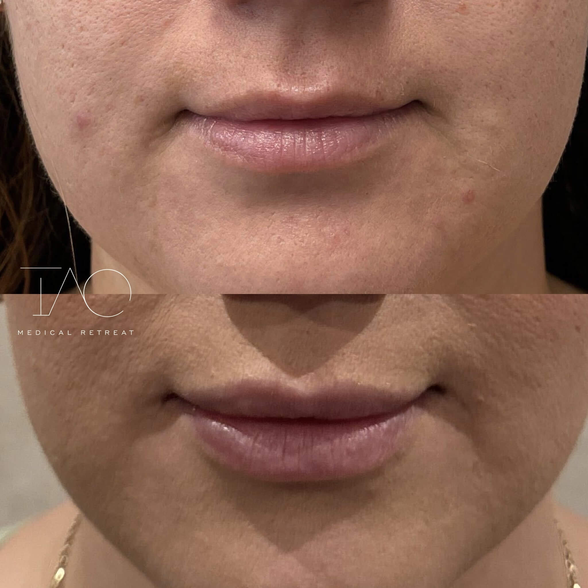 Lip Fillers Before & After Photos | TAO Medical Spa