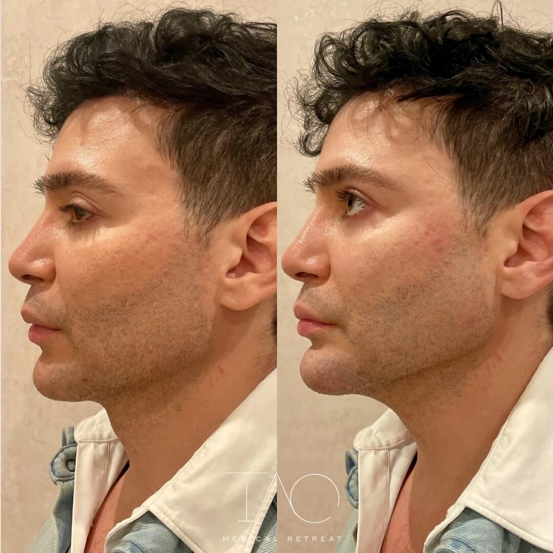 Radiesse Before & After Photos | TAO Medical Spa