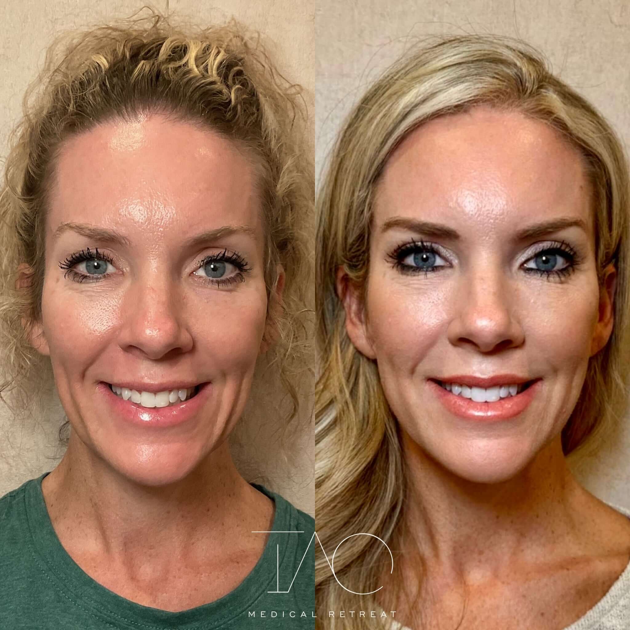 Radiesse Before & After Photos | TAO Medical Spa