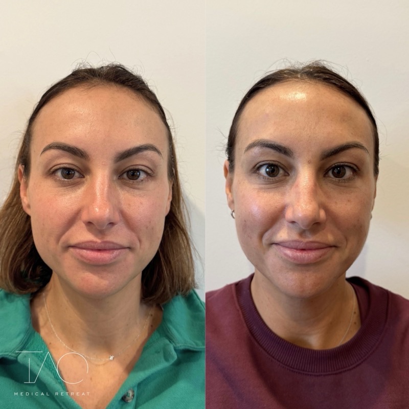 Radiesse Before & After Photos | TAO Medical Spa