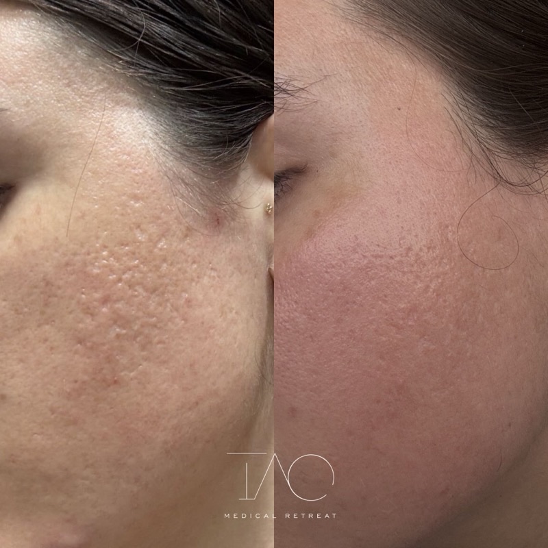 UltraClear Laser Before & After Photos | TAO Medical Spa